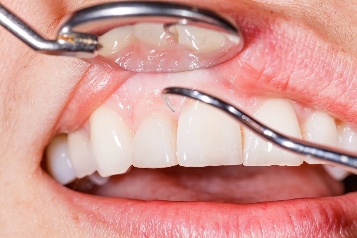 Is Gum Disease the Culprit Behind Your Loose Tooth? - West Orange